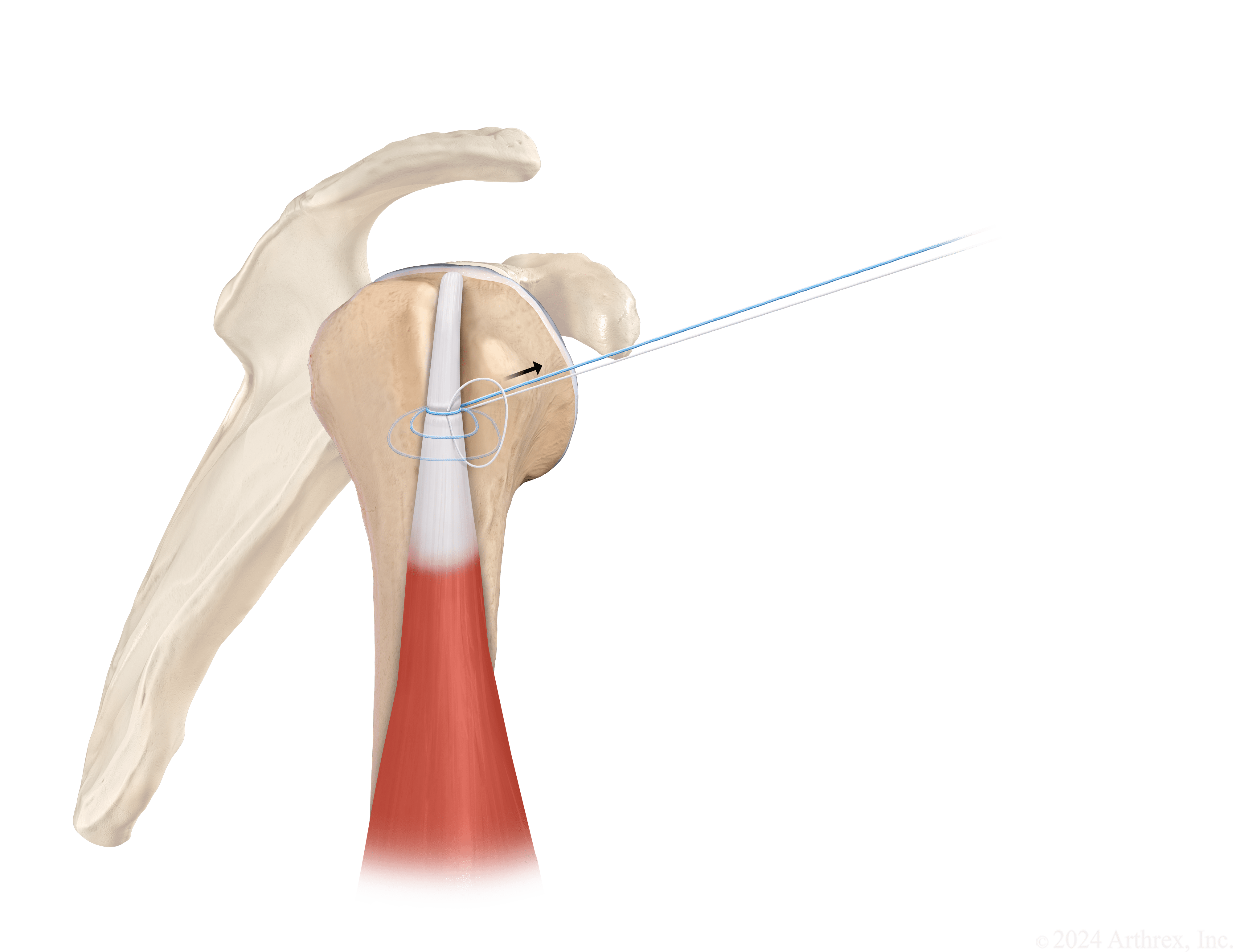 Biceps (Proximal & Distal) Procedure | OrthoPatient